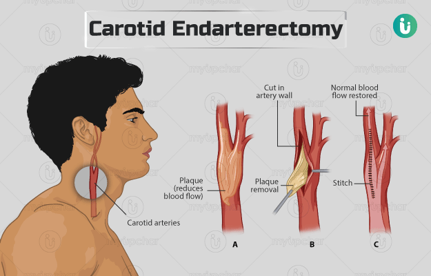 Carotid endarterectomy: Procedure, Purpose, Results, Cost, Price