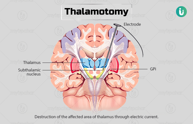 Thalamotomy: Procedure, Purpose, Results, Cost, Price