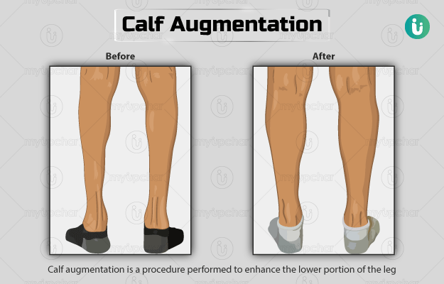 Calf augmentation: Procedure, Purpose, Results, Cost, Price