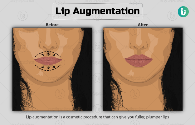 Lip Augmentation: Procedure, Purpose, Results, Cost, Price, Indications ...