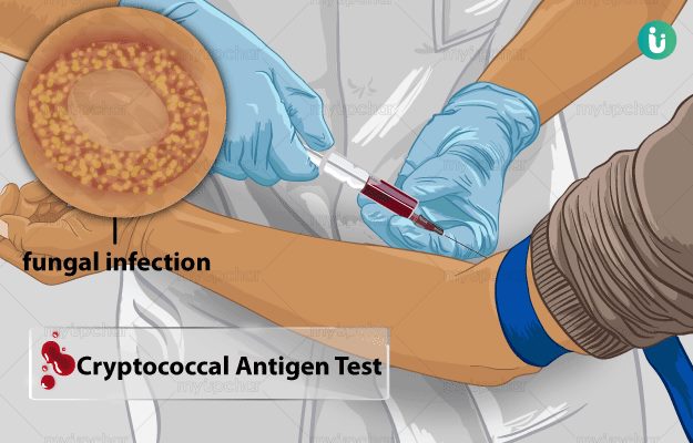 Cryptococcal Antigen Test: Procedure, Purpose, Results, Cost, Price ...